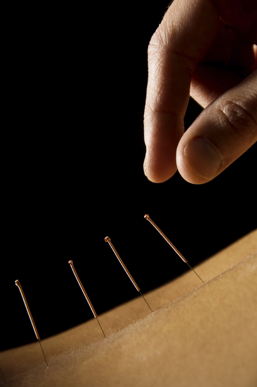 The 13 different styles of acupuncture – Acupuncture Times